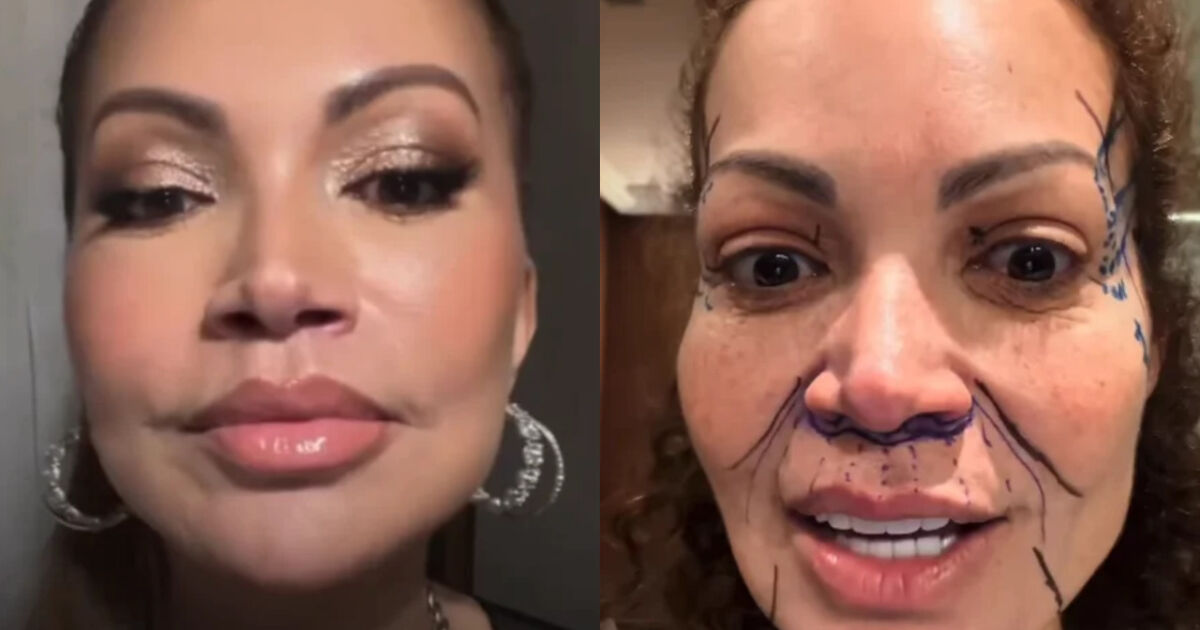 Solange Almeida mostra antes e depois de lifting facial e diz estar ...